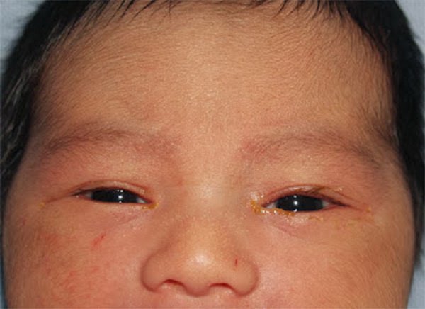 Dấu hiệu tắc tuyến lệ ở trẻ sơ sinh | Mytour