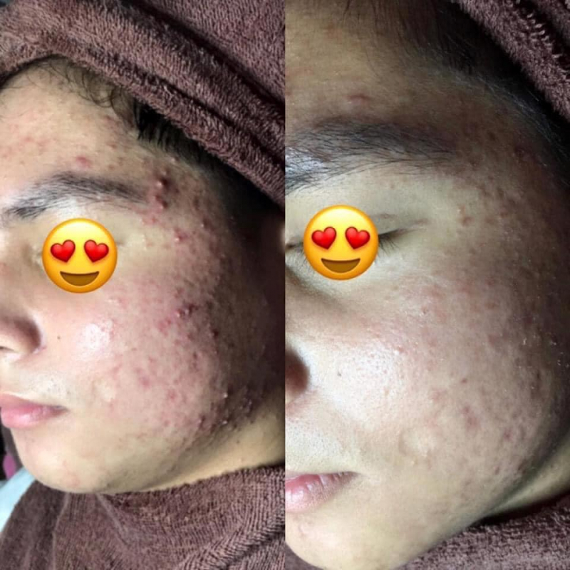 Top 6 Spa trị mụn tốt và hiệu quả nhất tại Phú Yên - Mytour.vn