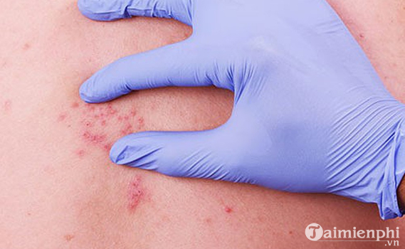 Bệnh Zona thần kinh: Nguyên nhân, triệu chứng, và cách điều trị