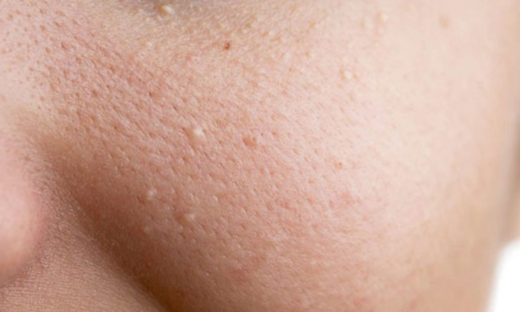 Understanding Hidden Acne: Effective Ways to Combat It | Mytour