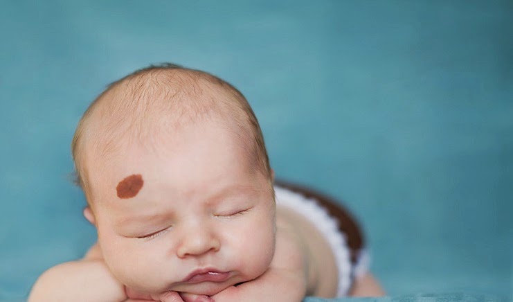 Benign and Malignant Spots on Your Baby's Body: How to Identify Them