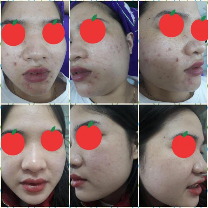 Top 8 Effective Acne Treatment Spas in Vinh City, Nghe An - Mytour.vn