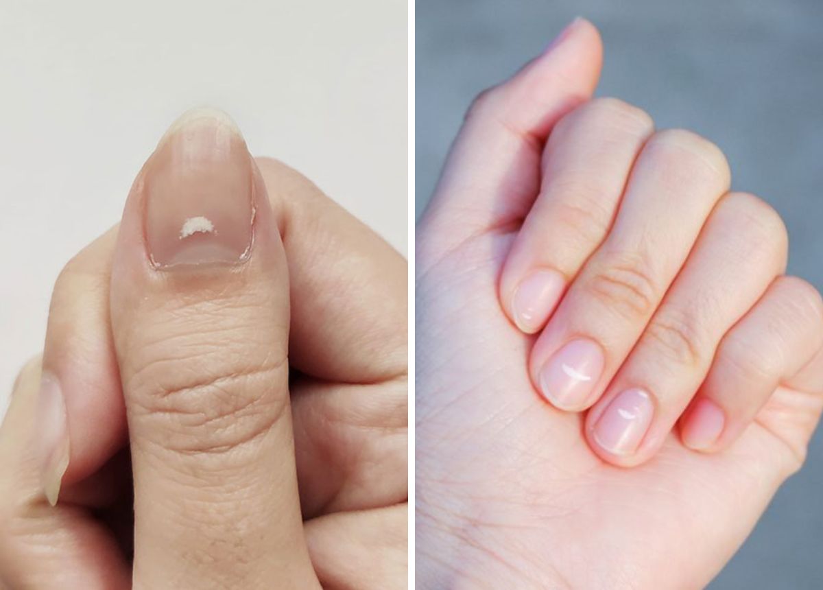 What Does White Spots on Nails Warn About? Is It Worrying? | Mytour