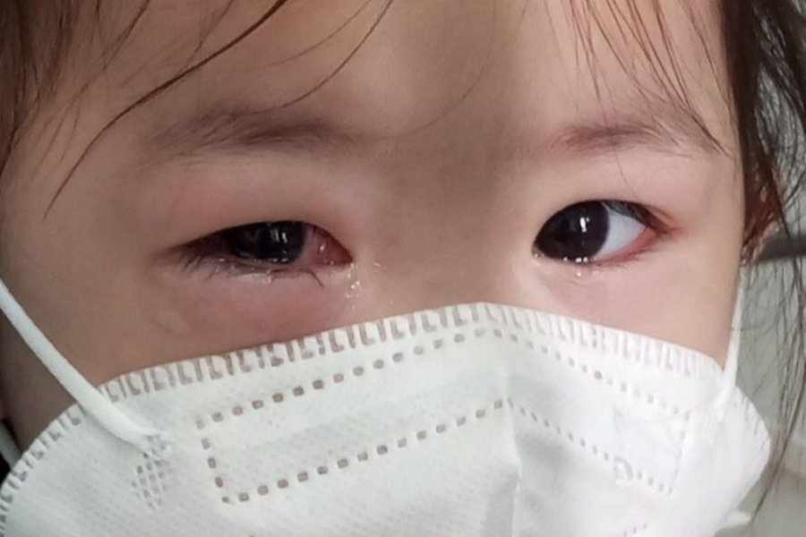 Red Eye Pain: Causes, Symptoms, and Effective Treatments