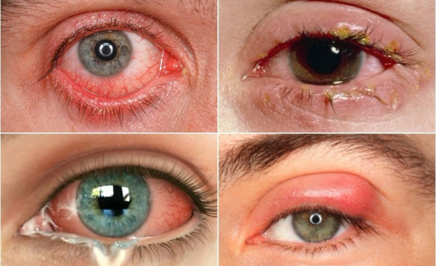 Red Eye Pain: Causes, Symptoms, and Effective Treatments