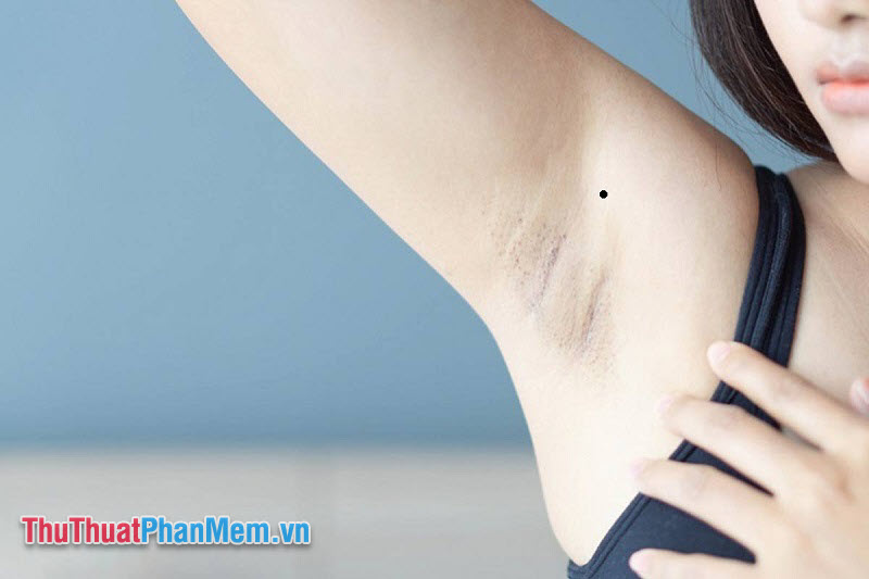 What's the Meaning of a Mole under the Armpit? Good or Bad?