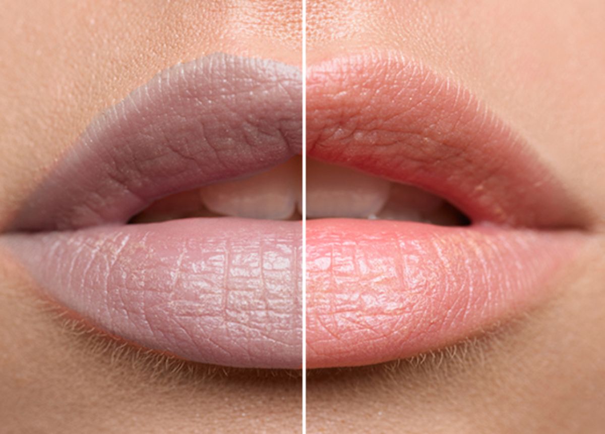 16 Ways To Quickly And Effectively Treat Lip Darkening At Home Mytour