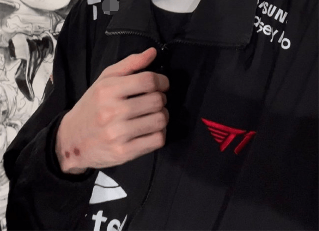 Faker reveals lingering injury from accident, evoking sympathy from fans