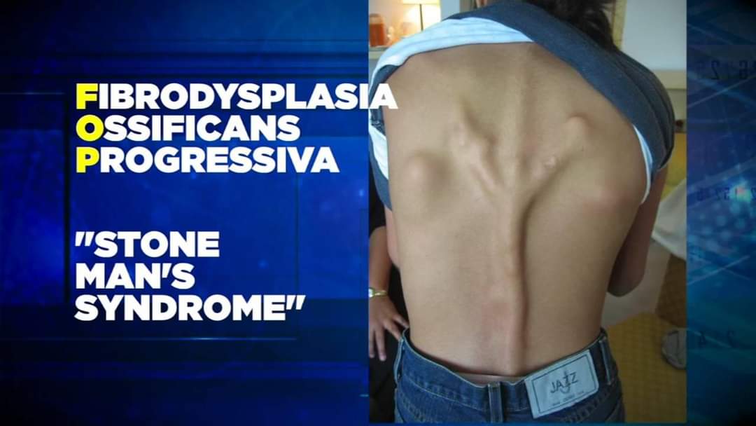 Anonychia - A rare condition that leads to the absence of fingernails ...