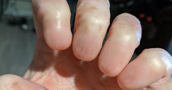 Anonychia - A rare condition that leads to the absence of fingernails ...