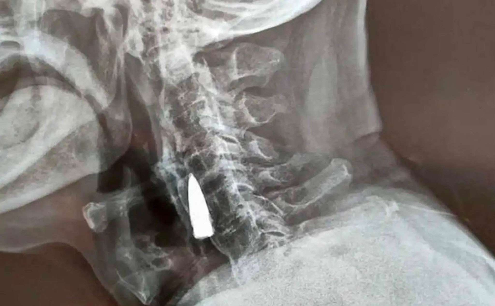 Elderly Man Lives Nearly 8 Decades with Bullet Lodged in Neck | Written ...