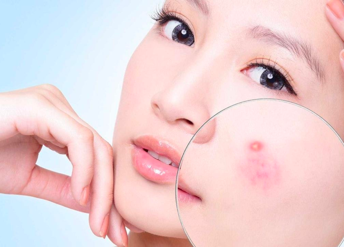What Are Blind Pimples? Causes, Symptoms, Home Remedies | Mytour