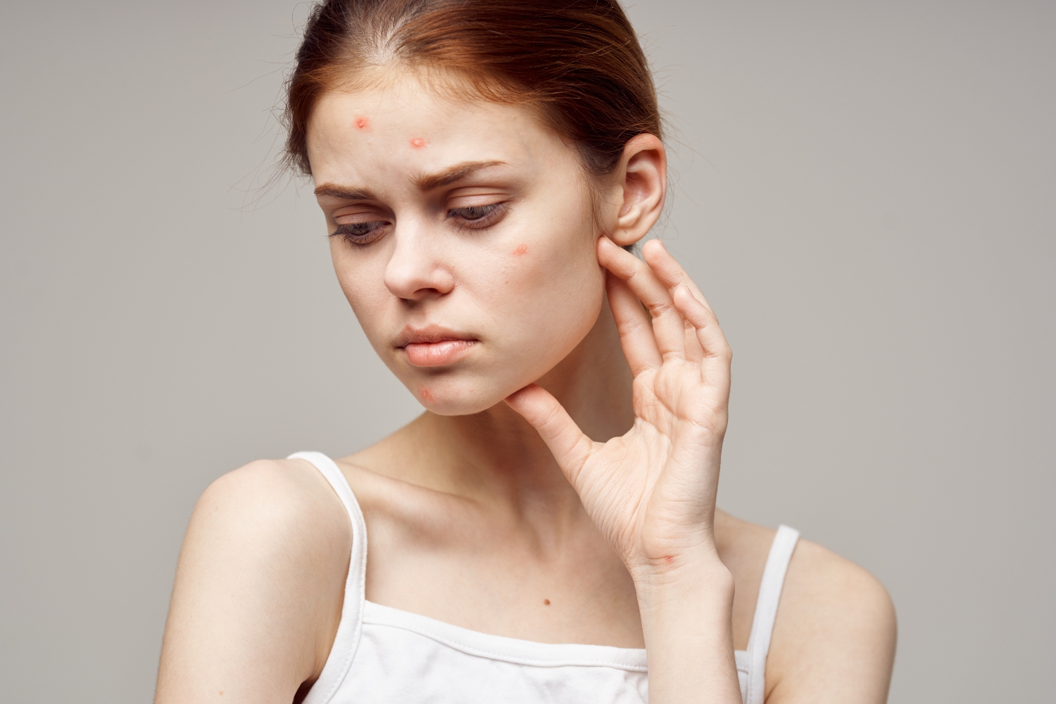 What Are Blind Pimples? Causes, Symptoms, Home Remedies | Mytour