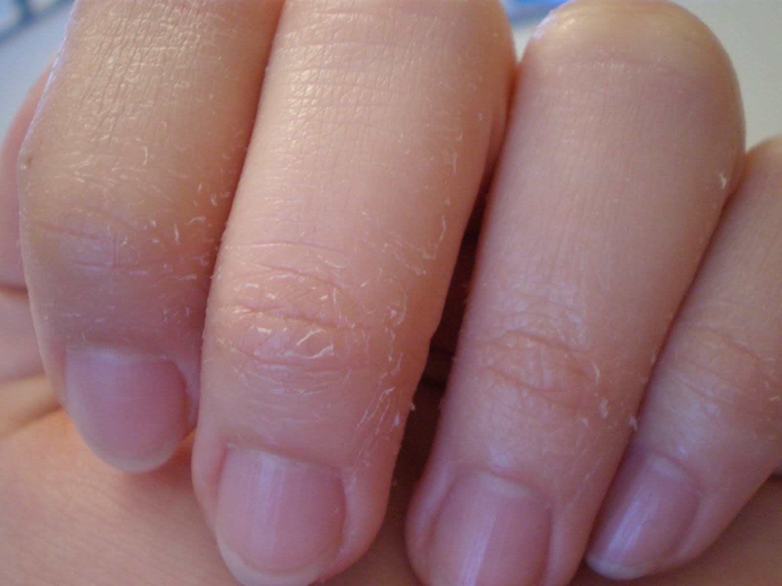 What Causes Hand Skin Peeling? Treatment and Prevention | Mytour