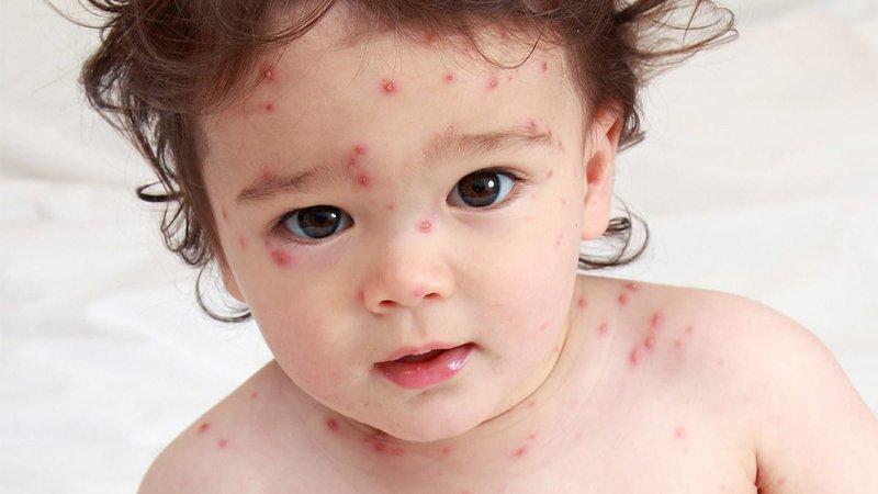 Top 7 Effective Herbal Bath Remedies for Chickenpox Every Mom Should ...