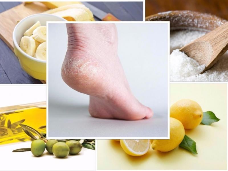 Top 10 Natural and Safe Ways to Treat Cracked Heels - Mytour.vn