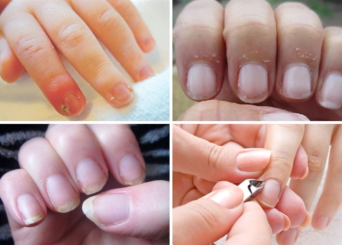 Causes and Treatment of Nail Cuticle Scratching | Mytour