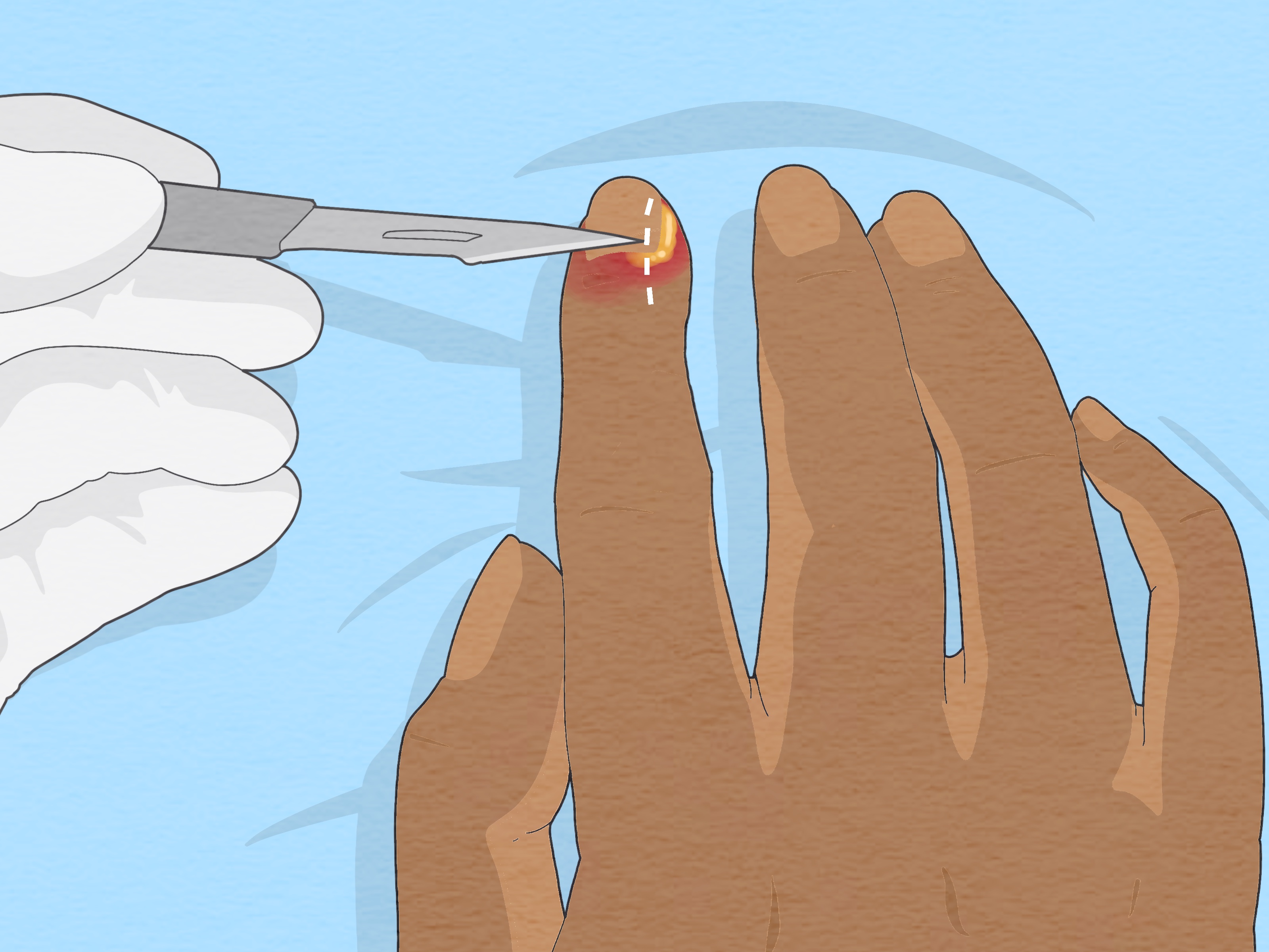 Effective Strategies for Managing Acute & Chronic Paronychia: Insights ...