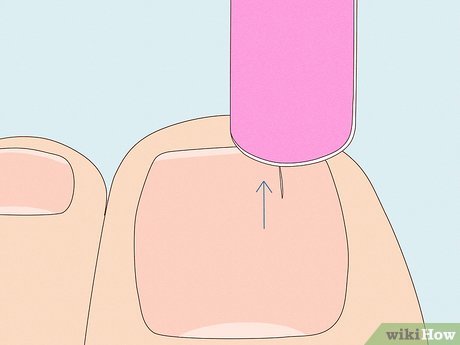 How to Mend a Split Toenail: Causes, Remedies, & More