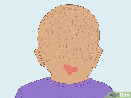 Symbolic Meanings of Angel Kiss Birthmarks