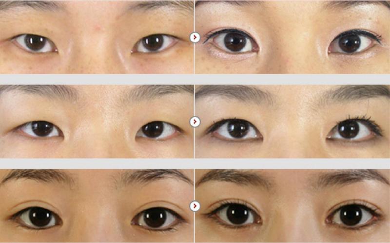 Top 7 Best Places for Eye Corner Surgery in Hanoi - Mytour.vn