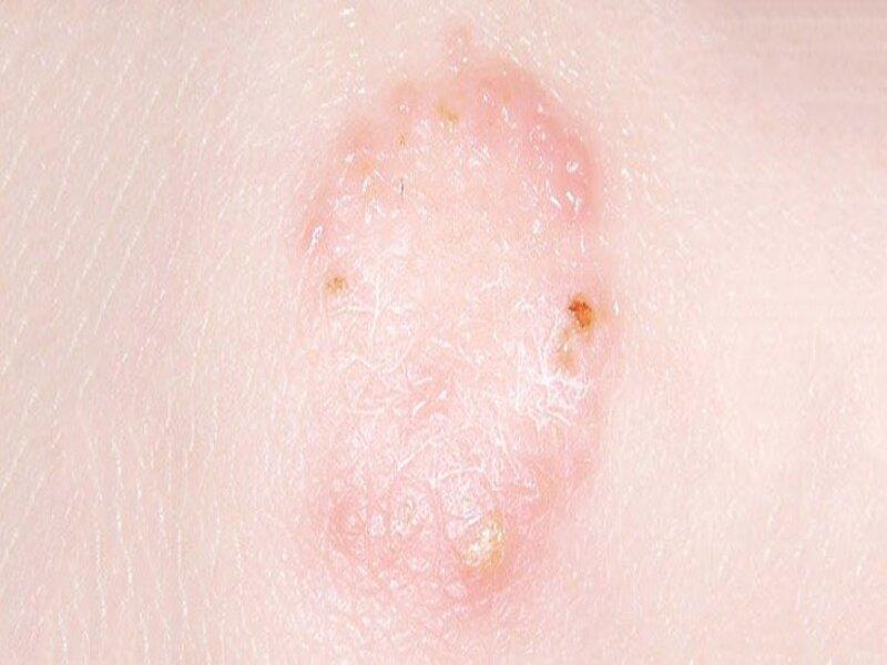 Top 6 Best Antifungal Creams Available Today - Mytour.vn