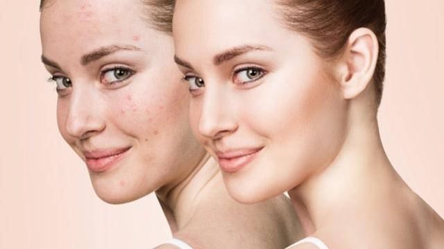Top 10 Best Acne Treatment Creams - Mytour.vn