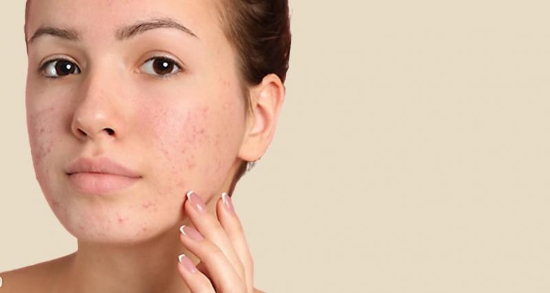 Top 10 Affordable and Effective Acne Creams You Should Know About ...
