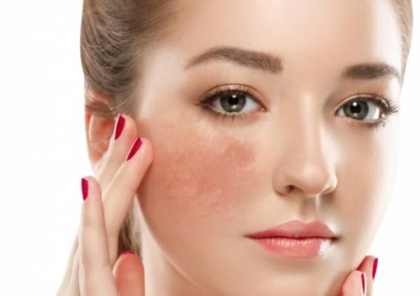 Top 10 Highly Effective Anti-Freckle and Anti-Dark Spot Creams Under 1 ...
