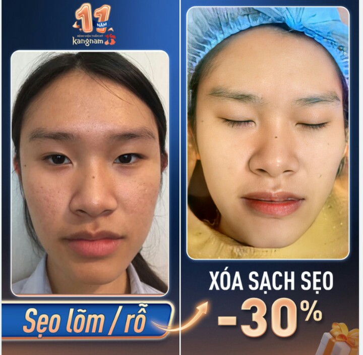 Top 12 Medical-Grade Clinics for Effective Acne and Pockmark Scar ...