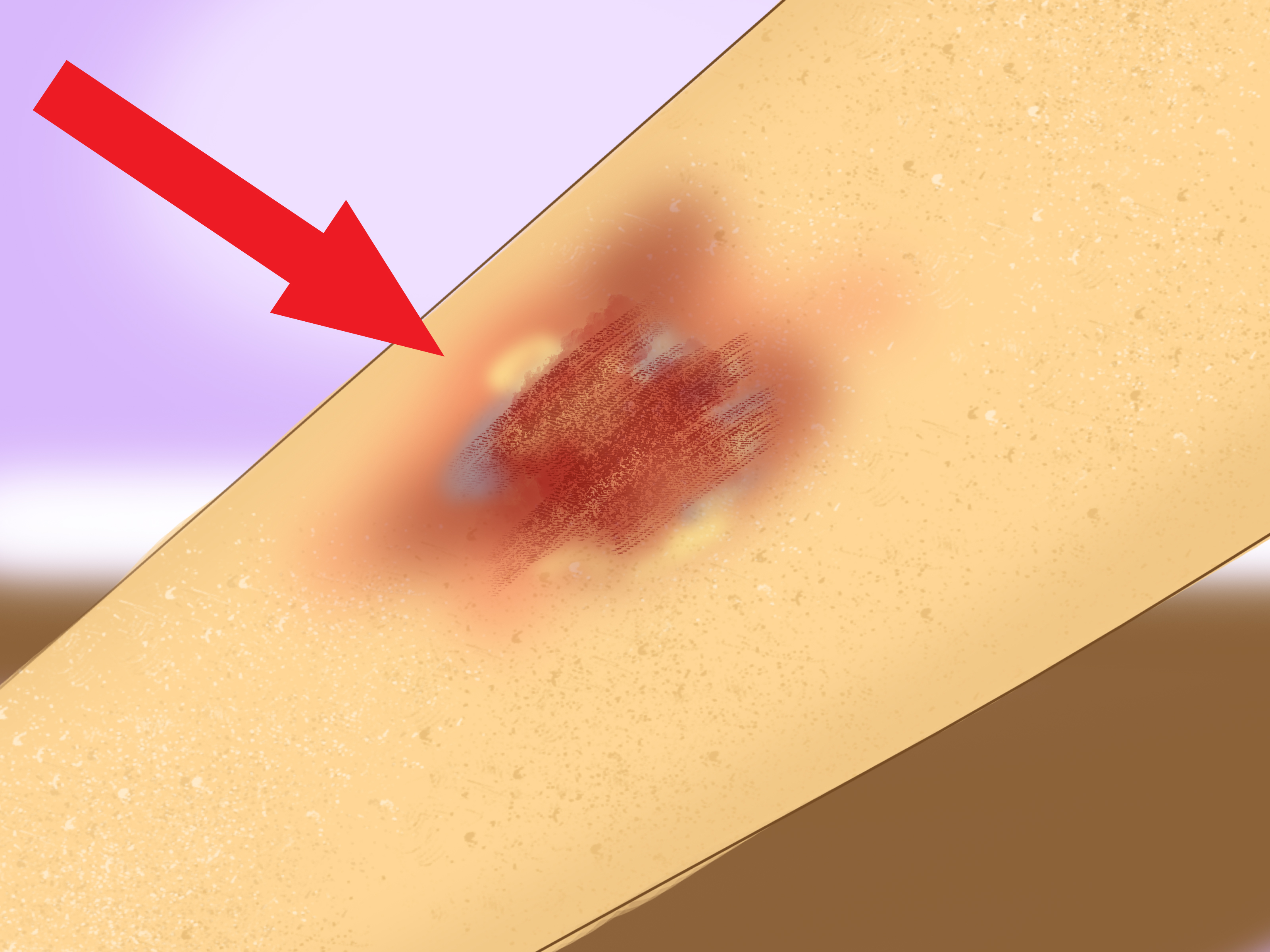 How to Treat Minor Wounds and Skin Scratches: A 7-Step Guide (with Images)