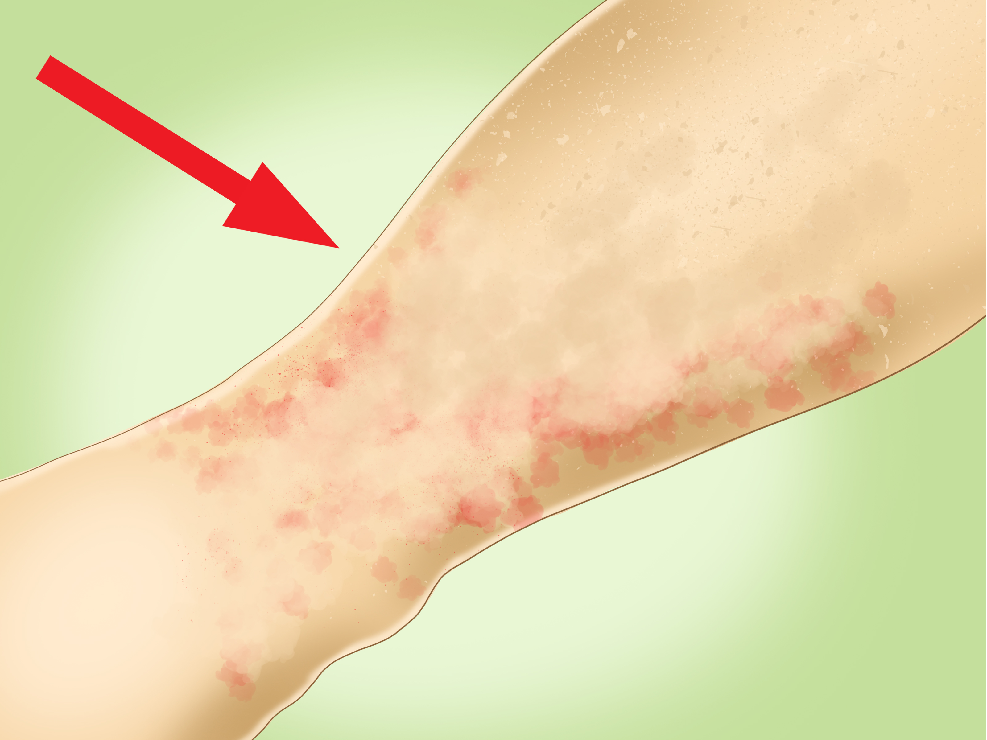 How to Treat Petechial Spots: A Step-by-Step Guide (with Images) – Mytour