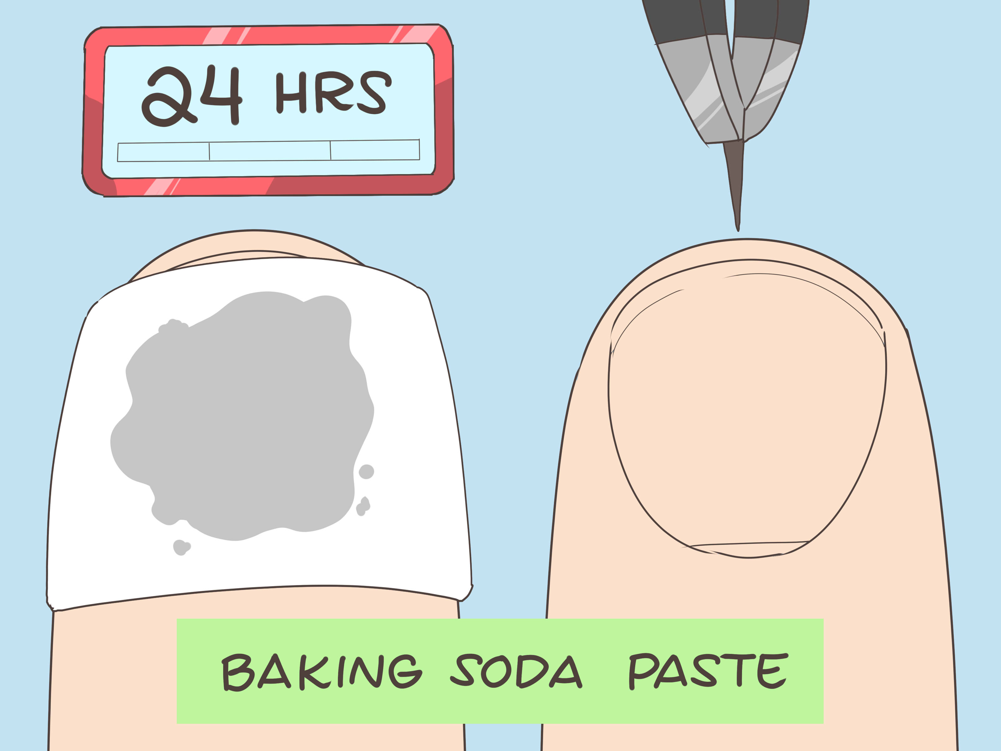 How to Remove a Splinter from Under Your Nail: 10 Steps (with Pictures ...