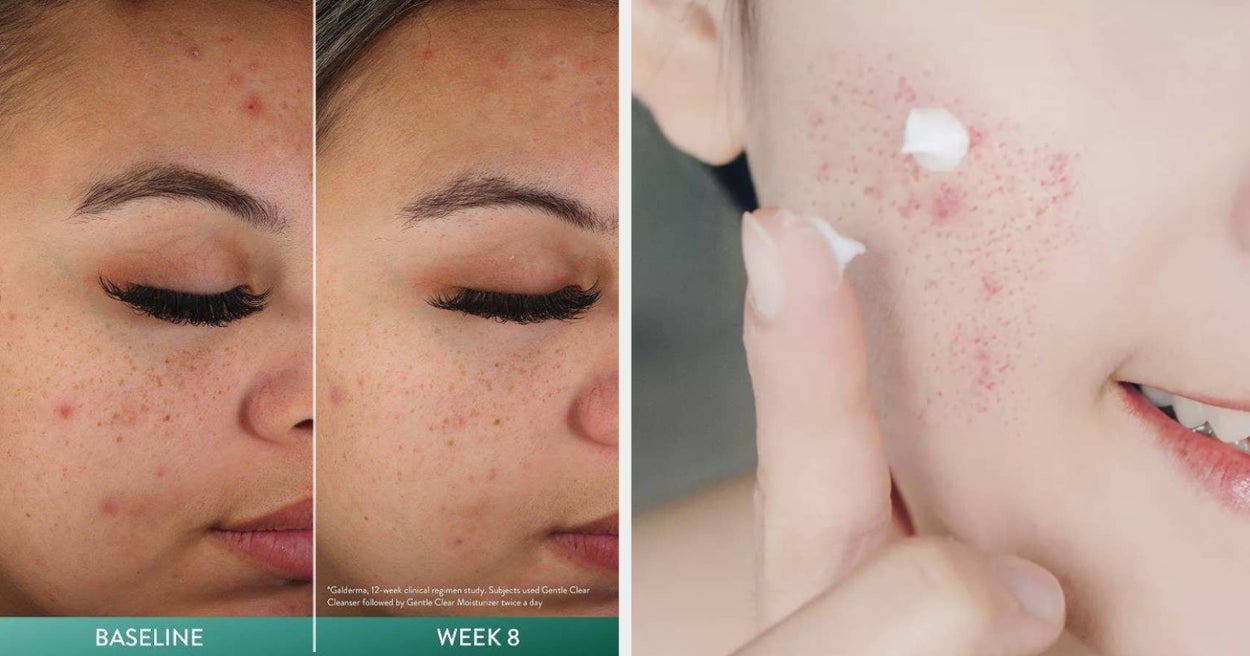 20 Quick and Effective Remedies to Combat Acne