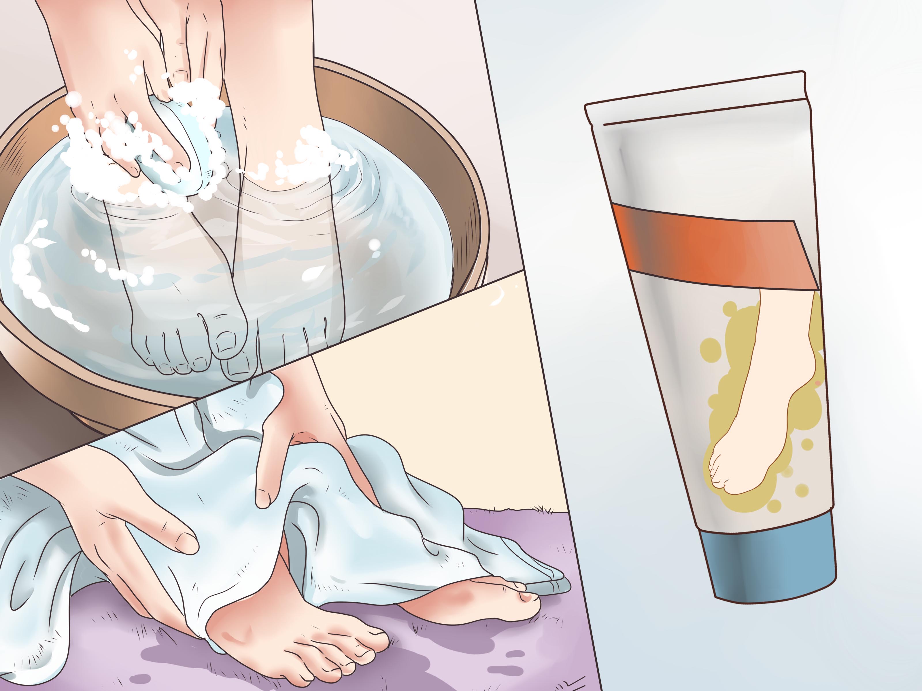 How to Treat Calluses – Mytour