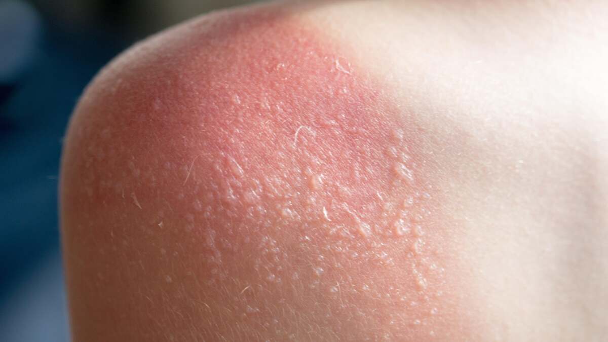 Effective Ways to Treat Sunburn Blisters | Mytour