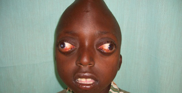 10 Individuals with Astonishing and Extreme Physical Deformities - Mytour