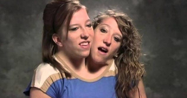 10 Fascinating Tales of Conjoined Twins - Mytour