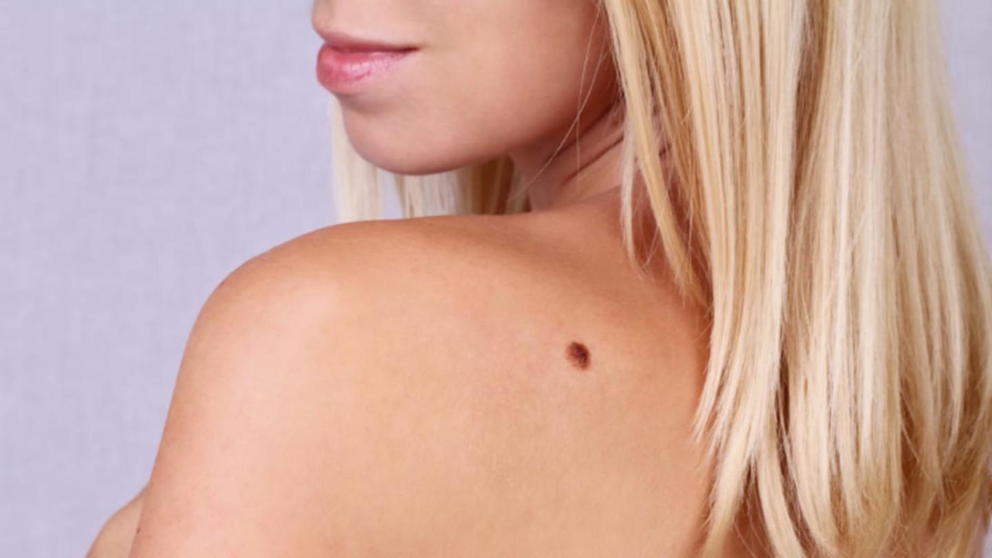 Why does hair on moles grow at a faster rate?