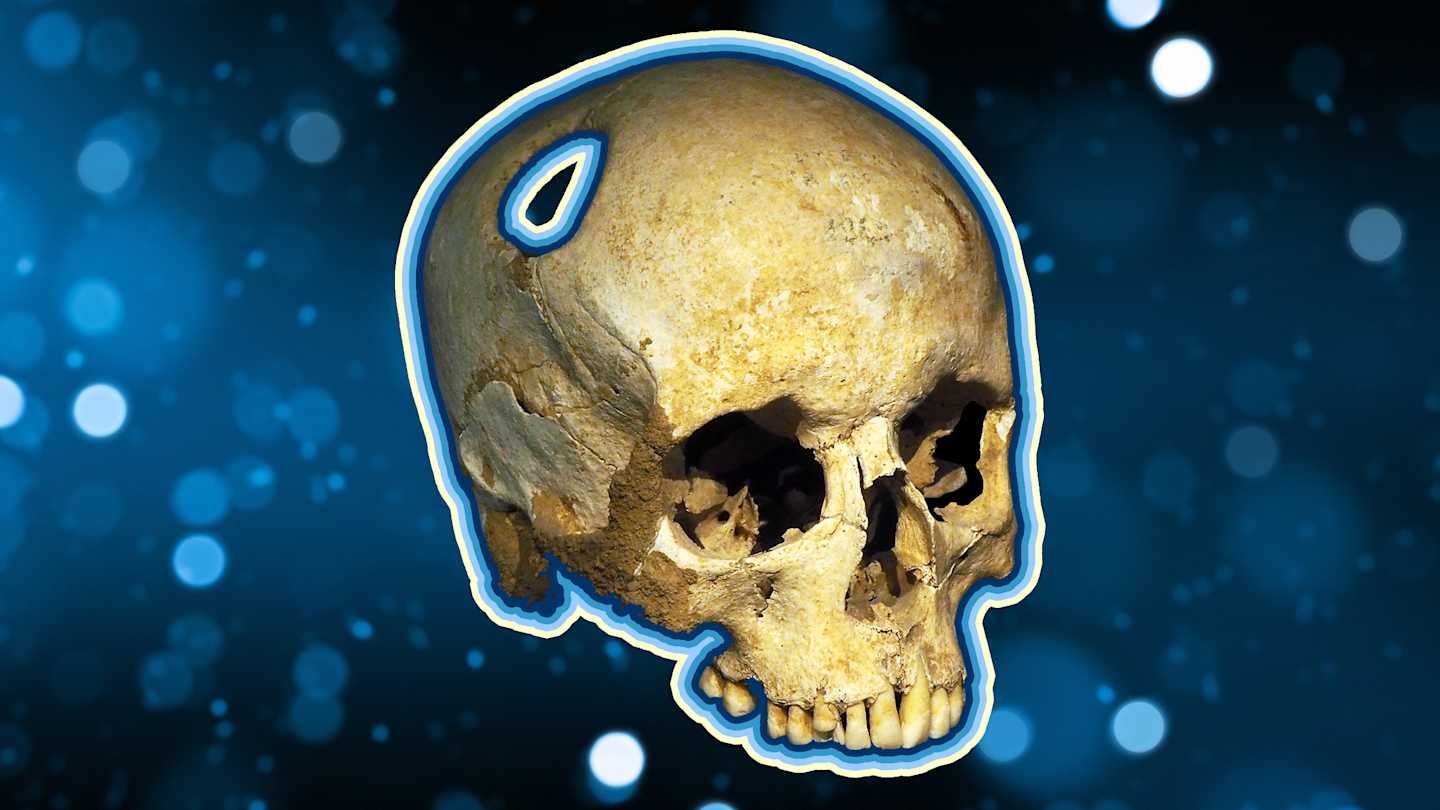 A Look Back at Trepanation, One of the Most Ancient Surgical Procedures ...