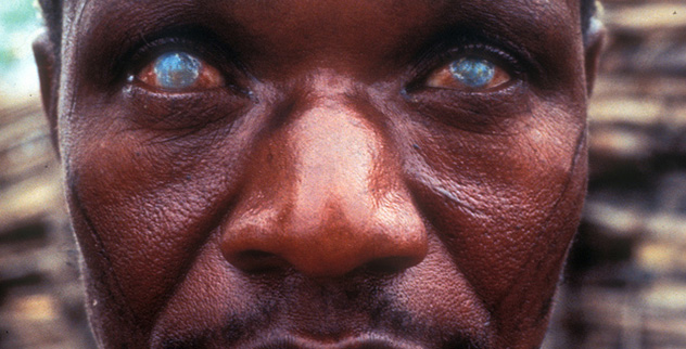 Top 10 Most Terrifying Parasite Infections - Mytour