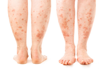 Understanding Solar Urticaria | Mytour