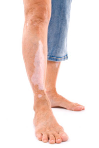 Understanding Skin Discoloration: A Comprehensive Guide | Mytour