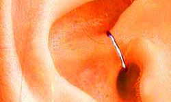 Is Ear Stapling a Viable Method for Weight Loss?