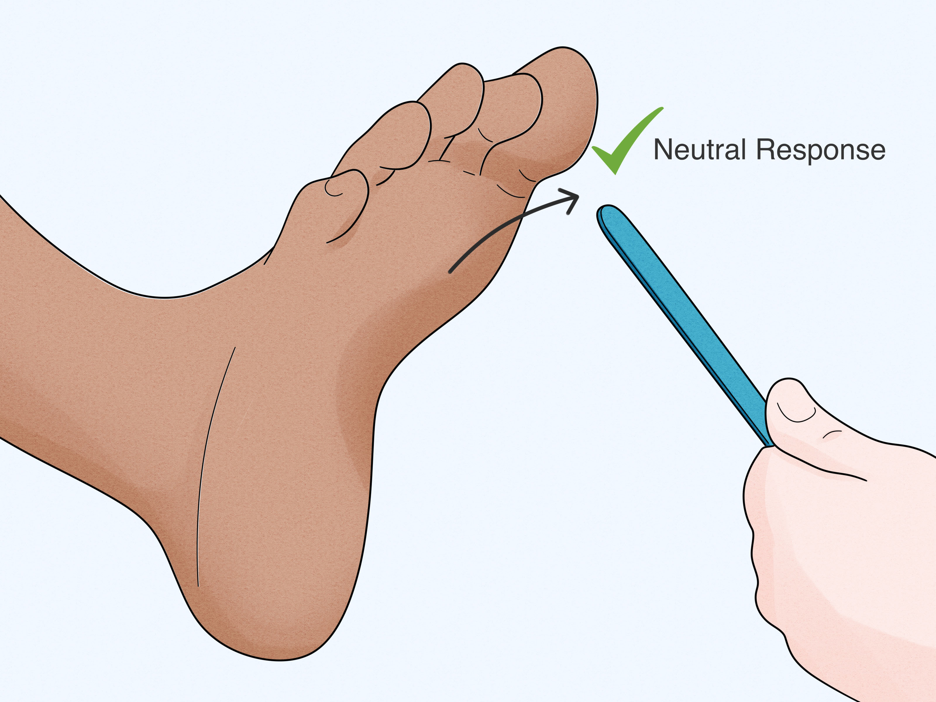Understanding the Babinski Reflex: A Comprehensive Guide